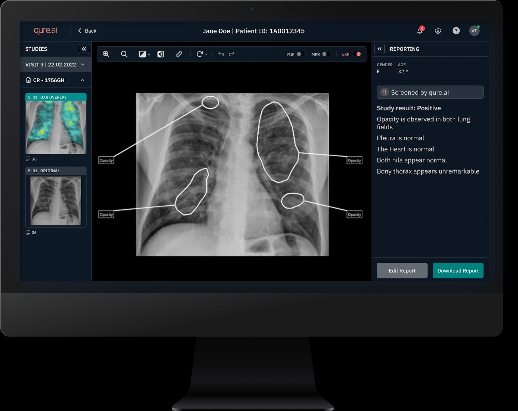 Using Artificial Intelligence for faster Chest X-ray results | North East London Cancer Alliance